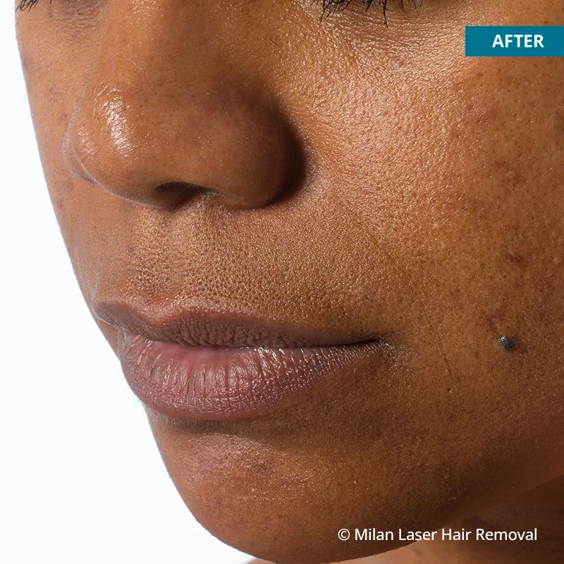 Face Before After Photos Of Laser Hair Removal Milan Laser In Face Before After Photos Of Laser Hair Removal Milan Laser In